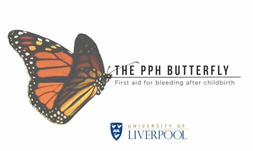 Device developed in Liverpool could help thousands of mums who bleed ...